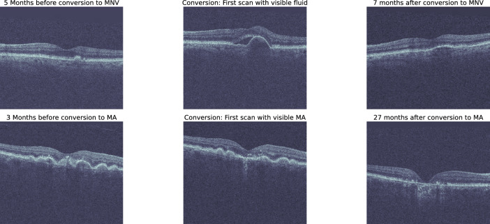 Automated deep learning-based AMD detection and staging in real-world OCT datasets (PINNACLE ...