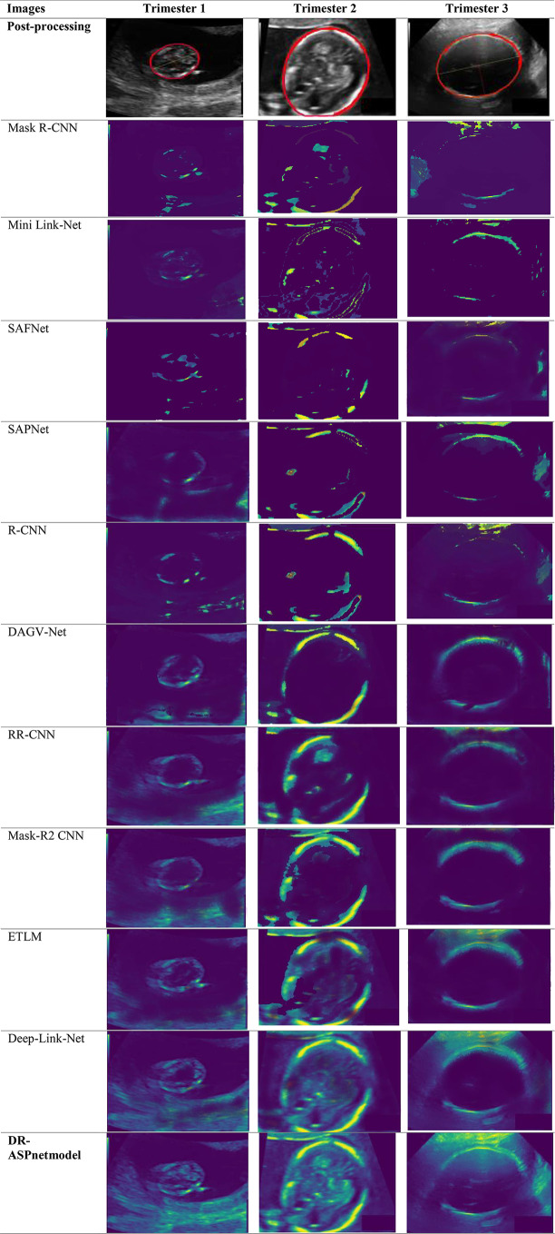 Fetal Ultrasound Segmentation and Measurements Using Appearance and ...