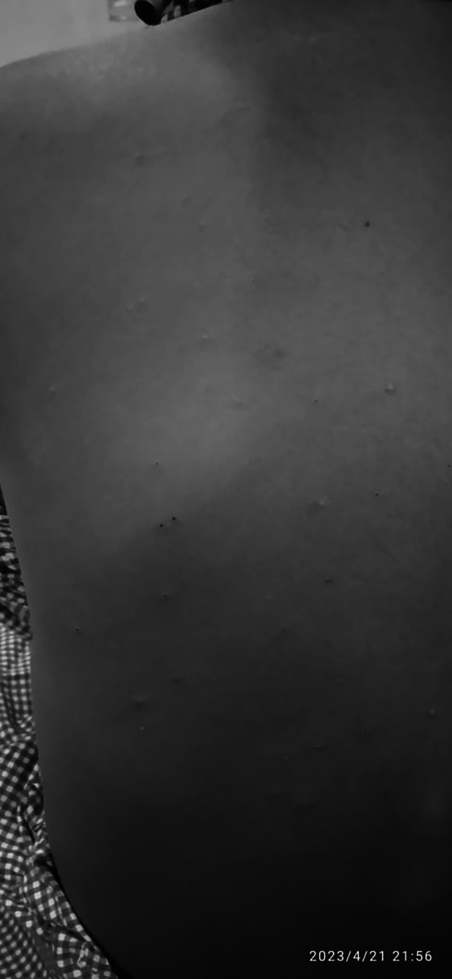 Successful Stem Cell Transplantation from Varicella Infected Donor - PMC