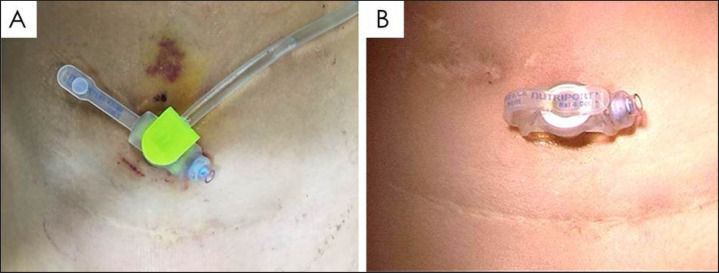 A Novel Vesicoscopic Bladder Wall Suture Fixation Technique to Aid ... A Novel Vesicoscopic Bladder Wall Suture Fixation Technique to Aid ...