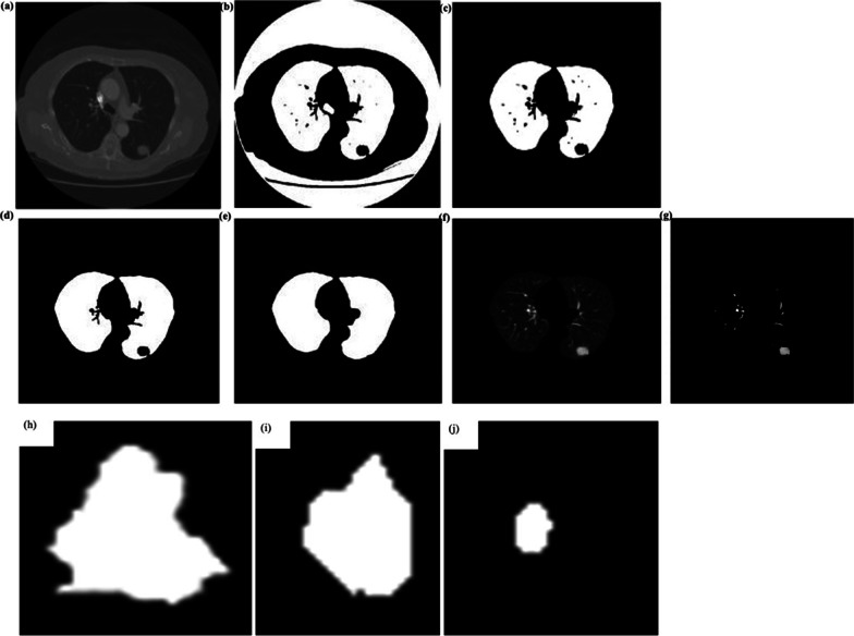 Lung nodule pre-diagnosis and insertion path planning for chest CT images - PMC