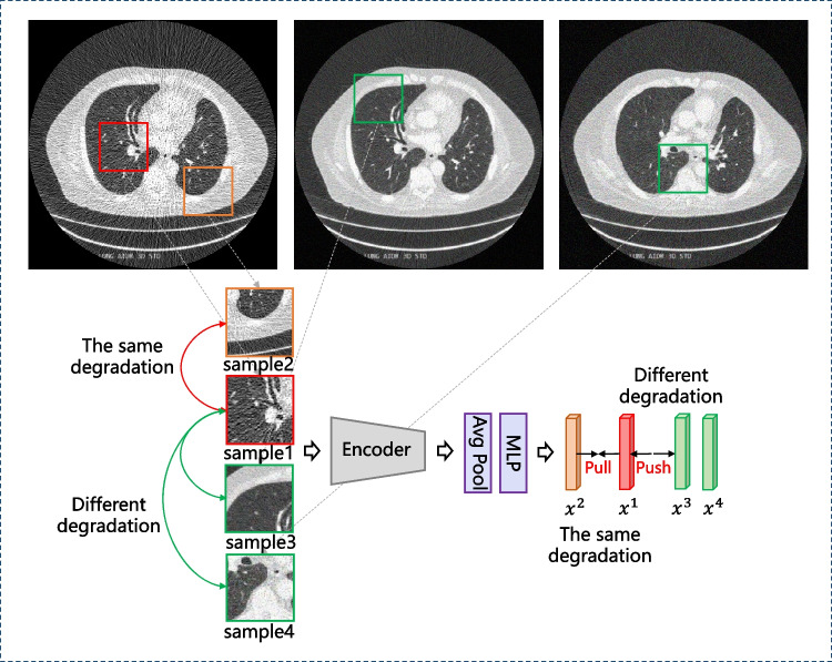 Degradation Adaption Local-to-Global Transformer for Low-Dose CT Image Denoising - PMC