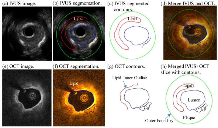 Combining IVUS + OCT Data, Biomechanical Models and Machine Learning Method for Accurate ...