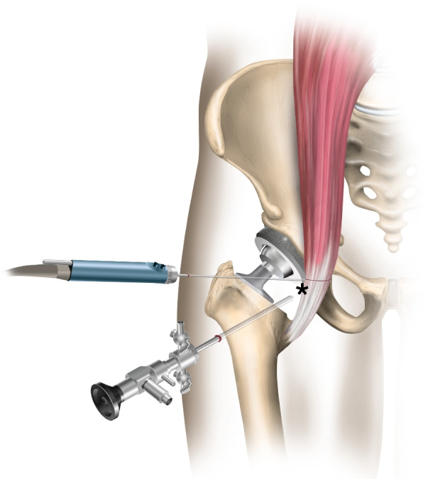 Arthroscopic iliopsoas tenotomy after total hip arthroplasty: safe method for the right patient ...