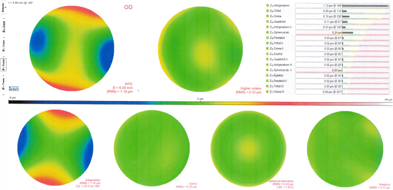 Corneal higher order aberrations by Sirius topography and their relation to different refractive ...