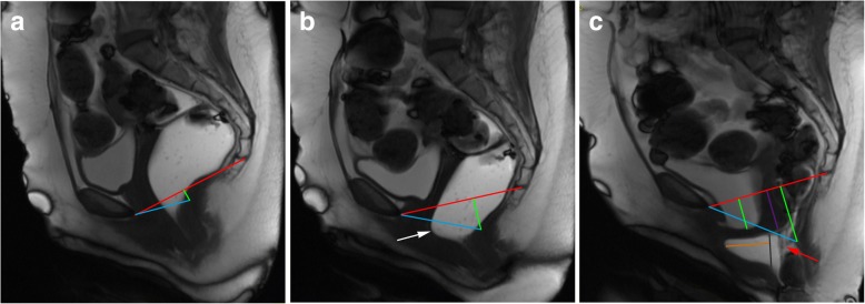 Dynamic Magnetic Resonance Imaging Of The Female Pelvic Floor—a Pictorial Review Pmc