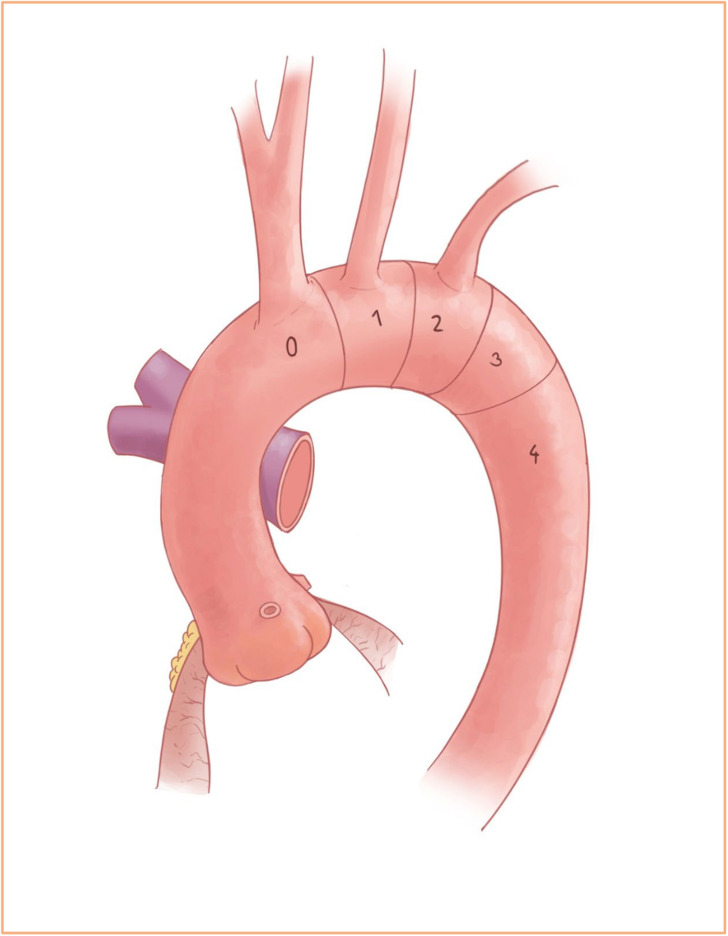 The 10 Commandments Of Open Aortic Arch Repair Pmc