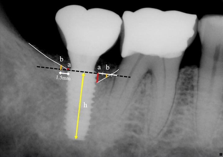 The effect of loading time on marginal bone change of implants immediately placed after ...