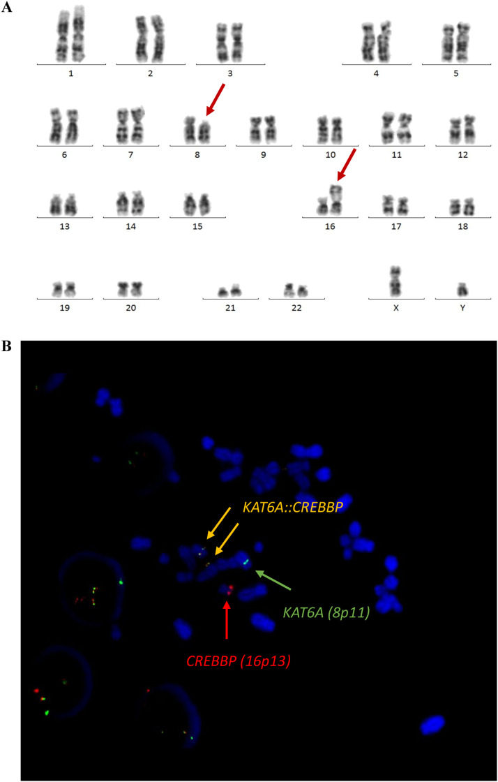 Fatal outcome of a rare acute myeloid leukemia with t(8;16)(p11.2;p13.3) and KAT6A::CREBBP gene ...