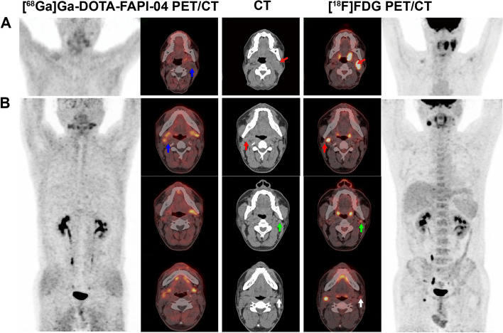 Head-to-head comparison of [68Ga]Ga-DOTA-FAPI-04 and [18F]FDG PET/CT for the evaluation of ...