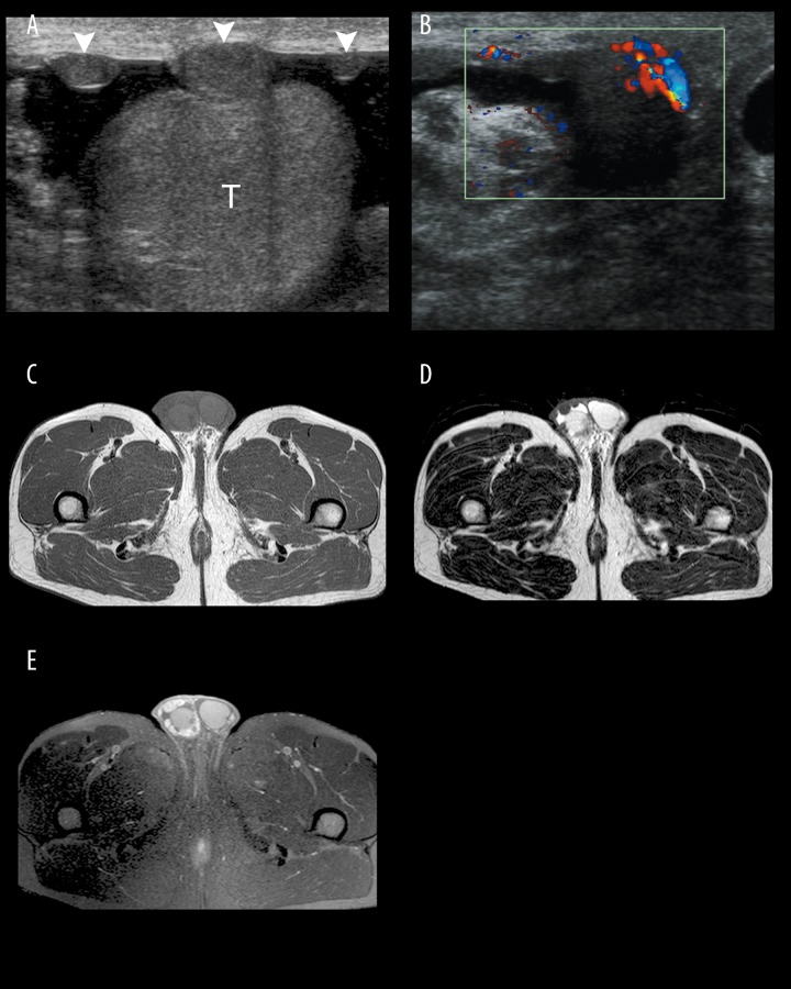 Imaging Appearances Of Paratesticular Fibrous Pseudotumor Pmc