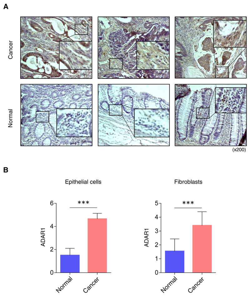 Activation of AZIN1 RNA editing is a novel mechanism that promotes ... Activation of AZIN1 RNA editing is a novel mechanism that promotes ...