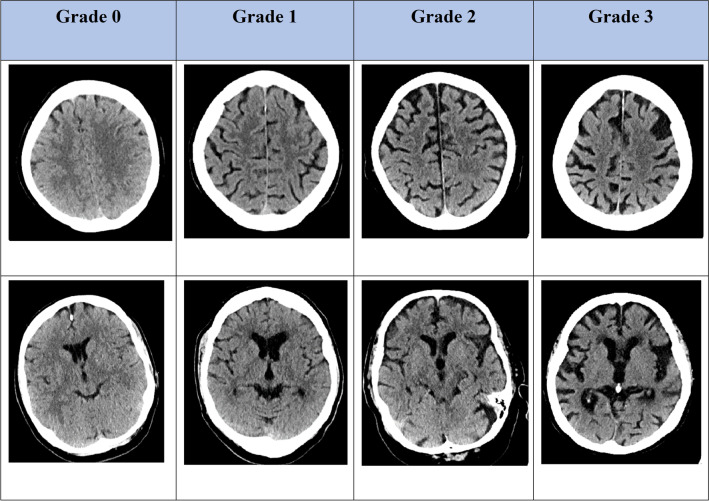 Cortical atrophy on baseline computed tomography imaging predicts clinical outcome in patients ...