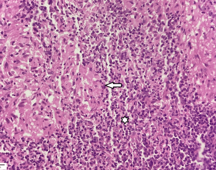 Lupus Miliaris Disseminatus Faciei A Report Of A Rare Case And Its