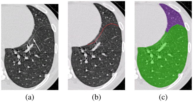 Anatomy-guided lung lobe segmentation in X-ray CT images - PMC