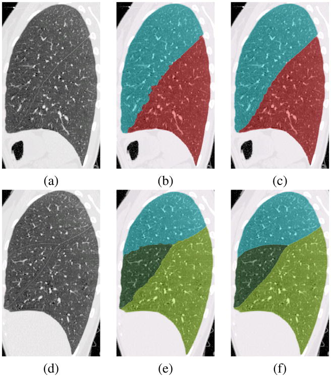 Anatomy-guided lung lobe segmentation in X-ray CT images - PMC
