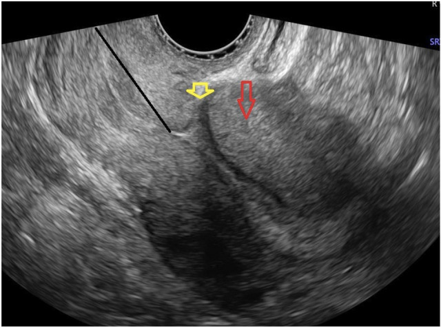 Effect of cervical changes on the cesarean scar area and niche ...