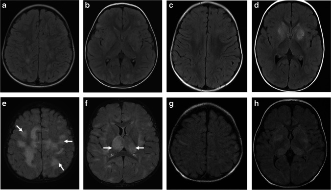 Radiological features in pediatric myelin oligodendrocyte glycoprotein antibody-associated ...