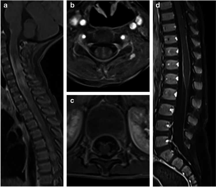 Radiological features in pediatric myelin oligodendrocyte glycoprotein antibody-associated ...