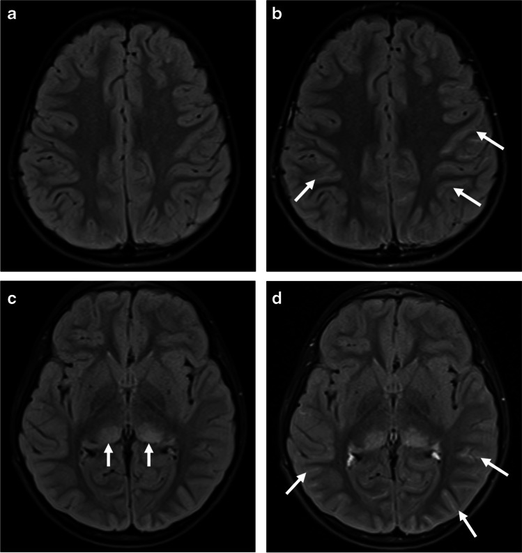 Radiological features in pediatric myelin oligodendrocyte glycoprotein antibody-associated ...