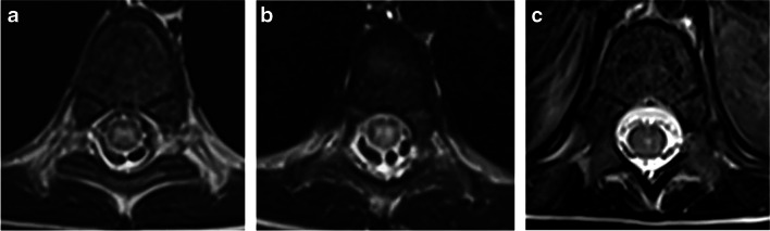 Radiological features in pediatric myelin oligodendrocyte glycoprotein antibody-associated ...