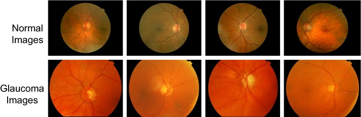 CNNs for automatic glaucoma assessment using fundus images: an extensive validation - PMC