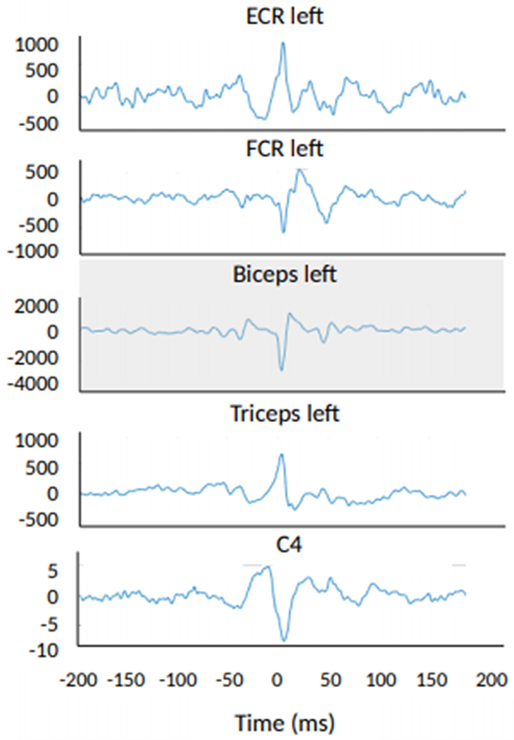 How to do an electrophysiological study of myoclonus - PMC