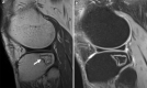 Subchondral insufficiency fracture of the knee: review of current concepts and radiological ...