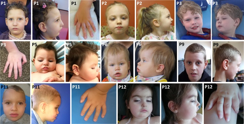 Spatially clustering de novo variants in CYFIP2, encoding the cytoplasmic FMRP interacting ...