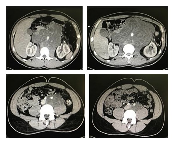 Growing Teratoma Syndrome Pmc