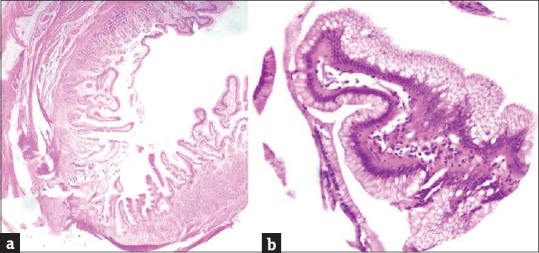Pseudocarcinomatous Hyperplasia Of The Fallopian Tube Mimicking A Tubal
