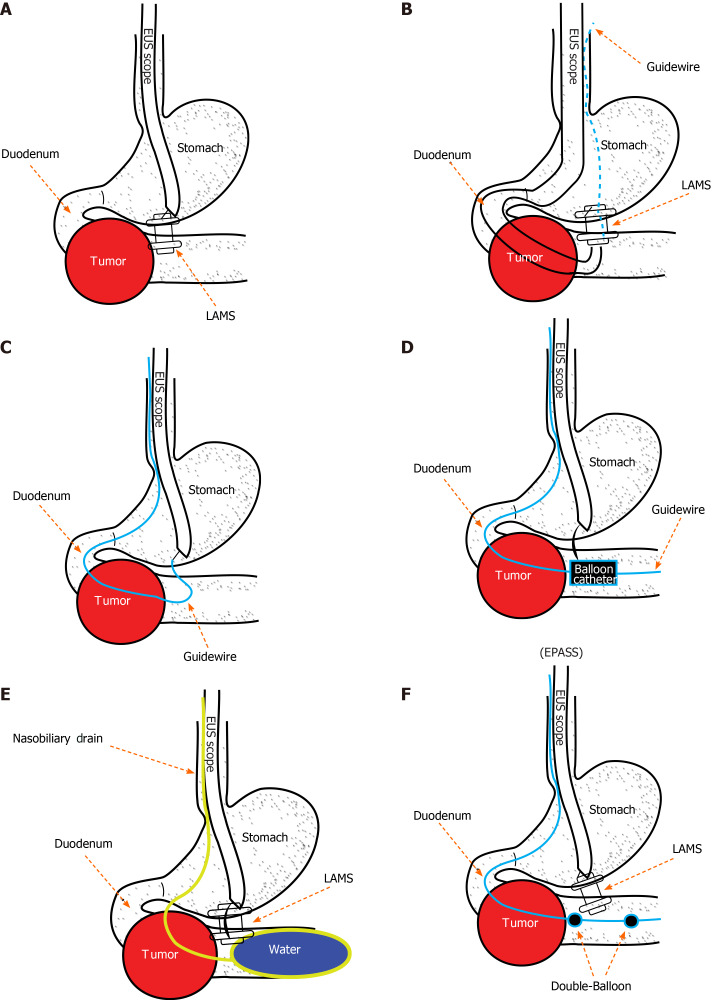 Endoscopic Ultrasound Guided Gastrojejunostomy For Gastric Outlet
