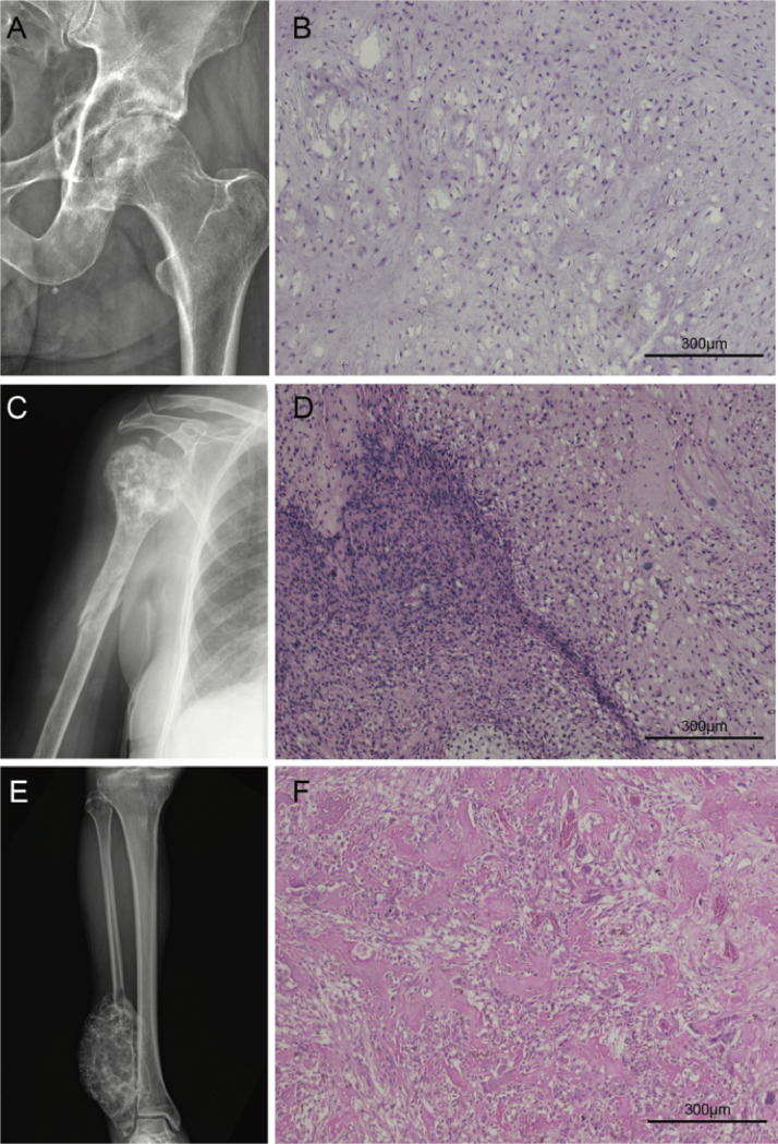 Clinical insights into circulating free-DNA in patients with bone sarcomas and ewing sarcoma - PMC
