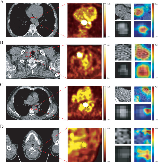 A 18F-FDG PET/CT-based deep learning-radiomics-clinical model for prediction of cervical lymph ...