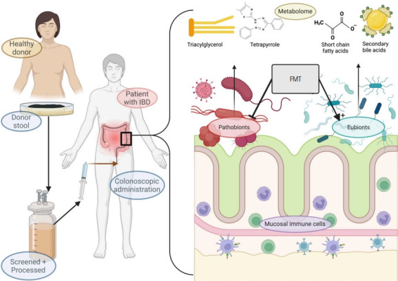 The practice of fecal microbiota transplantation in inflammatory bowel disease - PMC