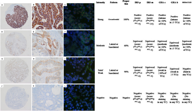 HER2 overexpression/amplification status in colorectal cancer: a ...