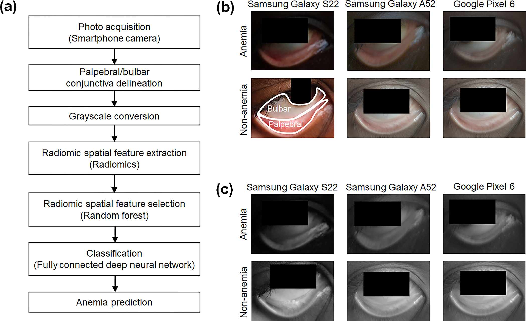 Radiomic identification of anemia features in monochromatic conjunctiva photographs in school ...