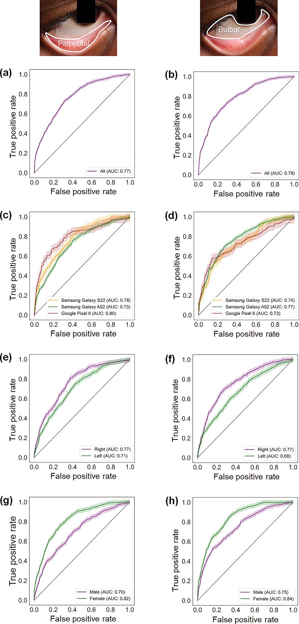 Radiomic identification of anemia features in monochromatic conjunctiva ...