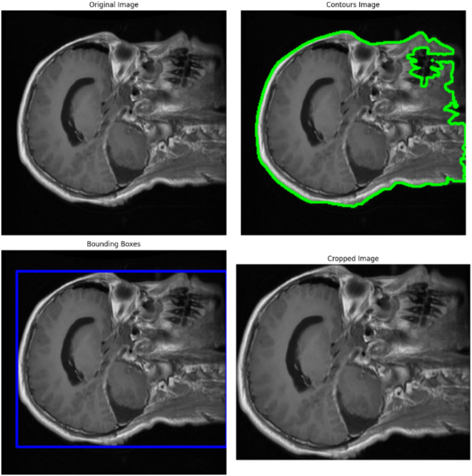 T1-weighted MRI-based brain tumor classification using hybrid deep learning models - PMC