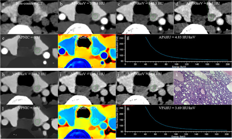 Nomogram based on spectral CT quantitative parameters and typical radiological features for ...