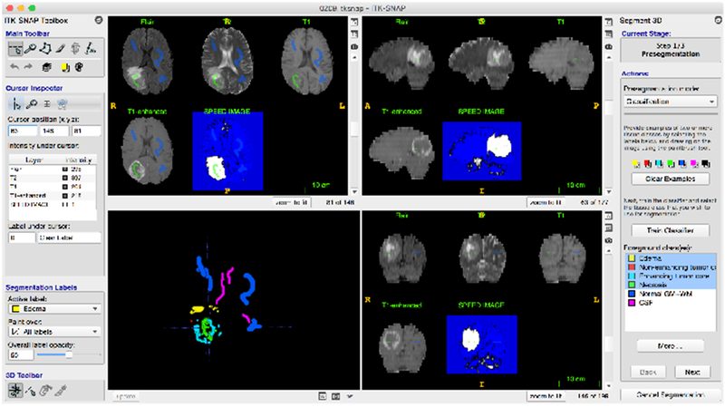 User-Guided Segmentation of Multi-Modality Medical Imaging Datasets with ITK-SNAP - PMC