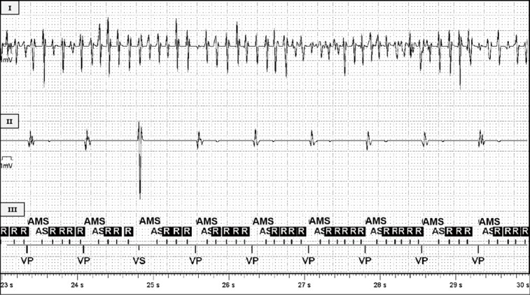 How to recognize silent atrial fibrillation in pacemakers and ...