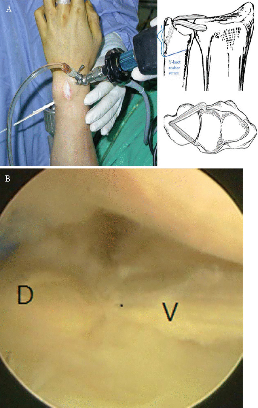 Arthroscopic triangular fibrocartilage complex reconstruction with free tendon graft for chronic ...