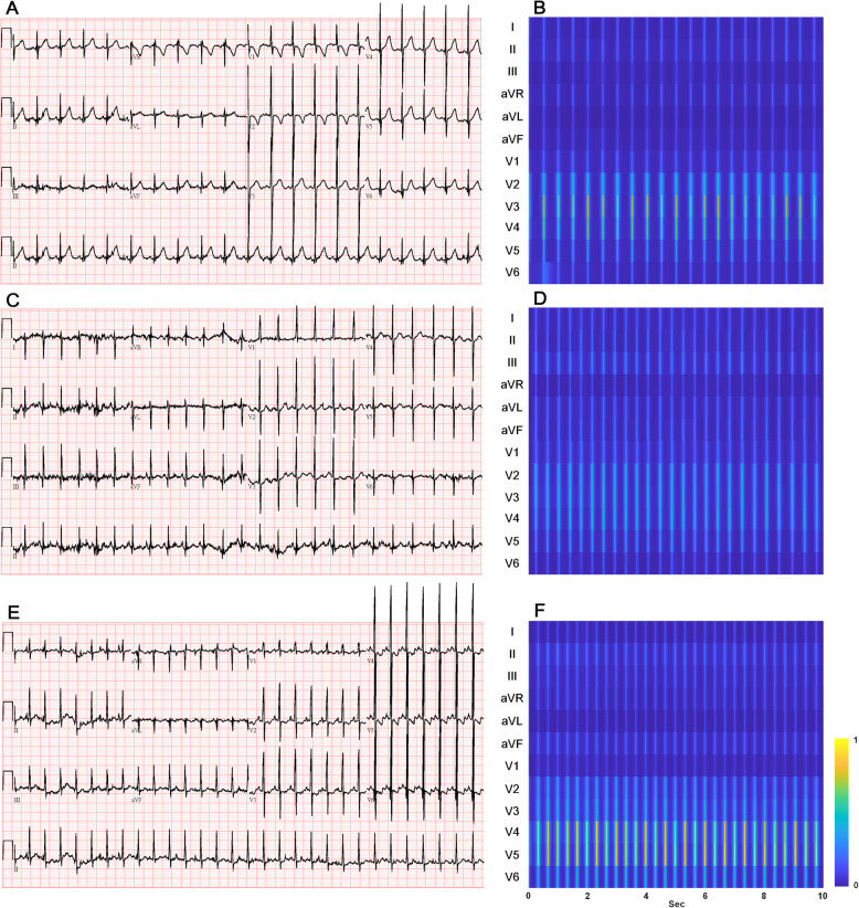 Prediction of significant congenital heart disease in infants and children using continuous ...
