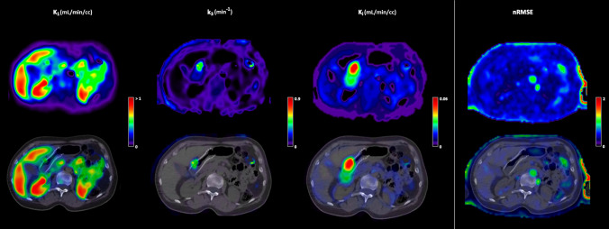 PET KinetiX—A Software Solution for PET Parametric Imaging at the Whole Field of View Level - PMC