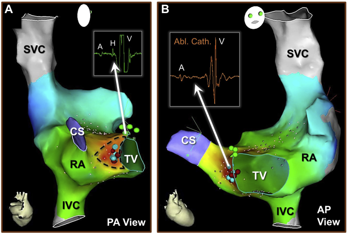 Catheter ablation of the atrioventricular node slow pathway sans fluoroscopy in a patient with ...