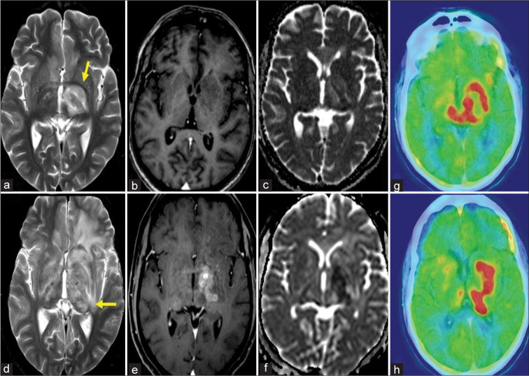 Diffuse Infiltrative Non-mass-like Brain Parenchymal Lesions on MRI ... Diffuse Infiltrative Non-mass-like Brain Parenchymal Lesions on MRI ...