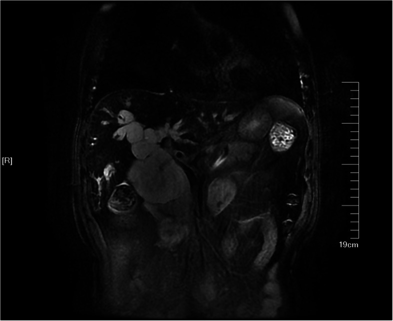 Type IV choledochal cyst with polycystic kidney disease: a case report - PMC