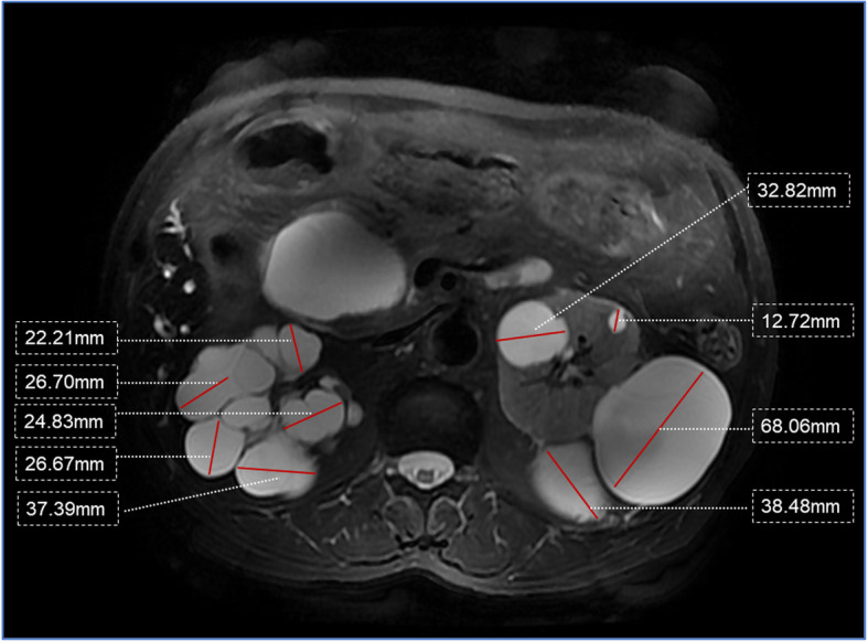 Type IV choledochal cyst with polycystic kidney disease: a case report - PMC