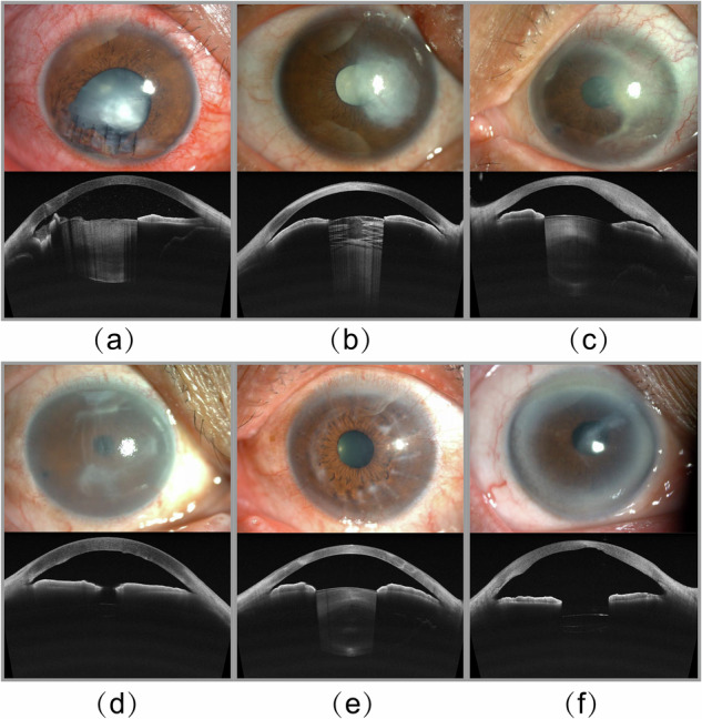 MCOA: A Comprehensive Multimodal Dataset for Advancing Deep Learning in Corneal Opacity ...